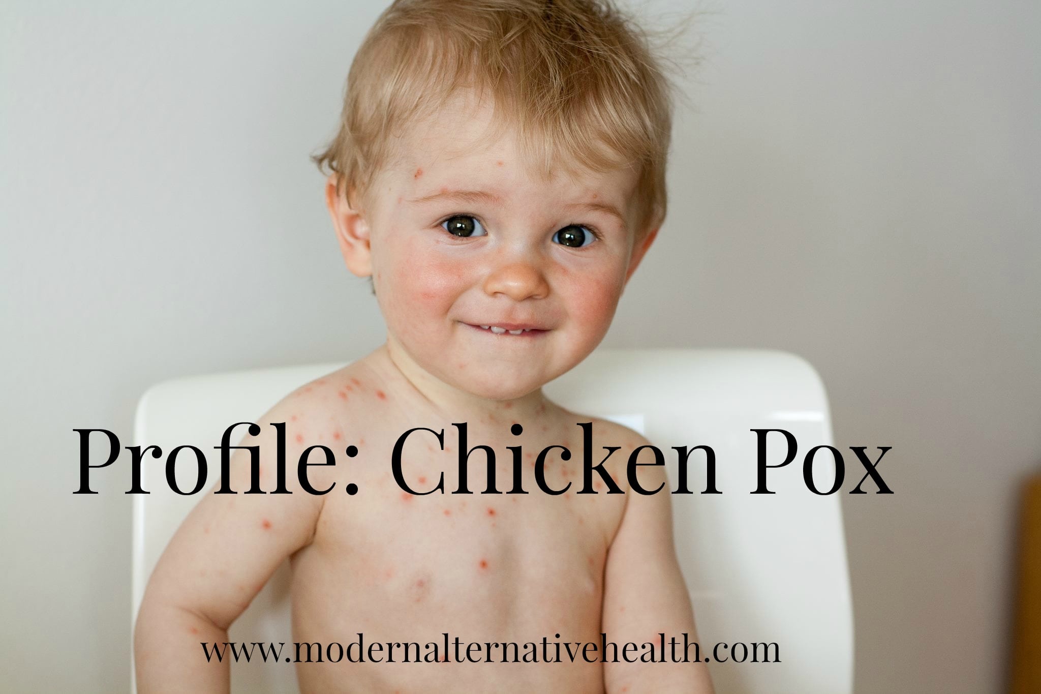 Chicken Pox What You Need To Know 